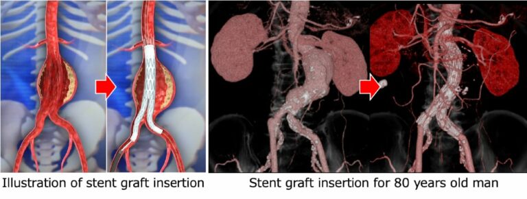 Treatment for abdominal aortic aneurysm | Vascular Surgery, The ...