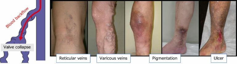What are varicose veins? | Vascular Surgery, The University of Tokyo