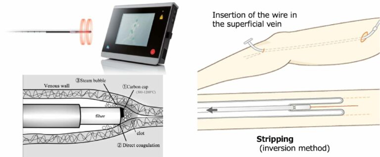 What are varicose veins? | Vascular Surgery, The University of Tokyo