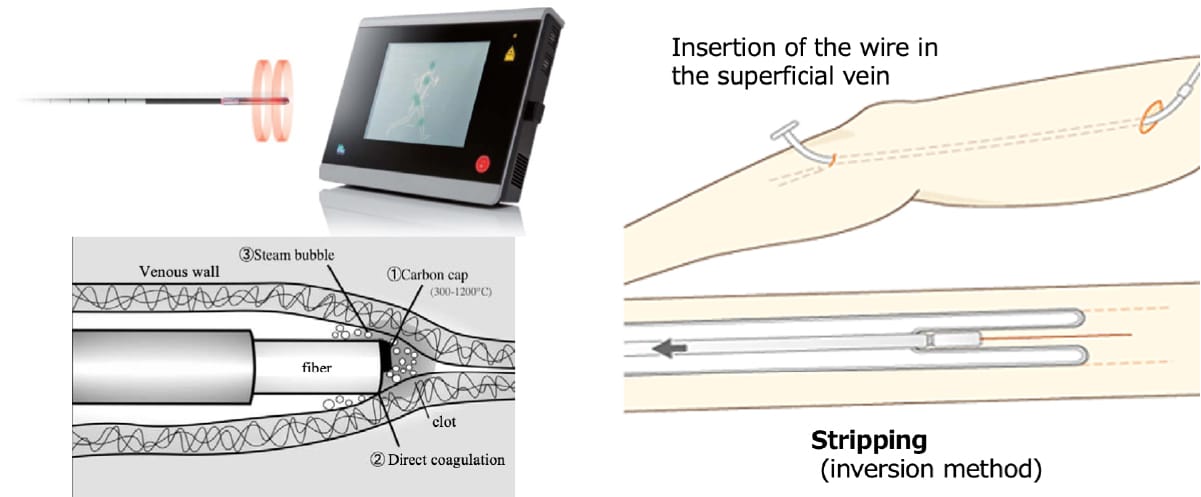 What are varicose veins? | Vascular Surgery, The University of Tokyo