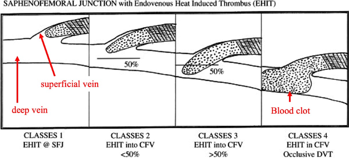 What are varicose veins? | Vascular Surgery, The University of Tokyo
